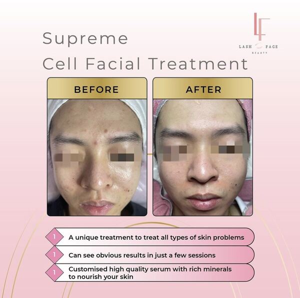 Best Facial Treatment For Acne-Prone Skin